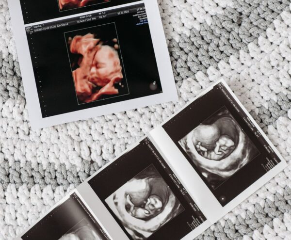 The Frequency of Pregnancy Scans: What to Expect During Each
